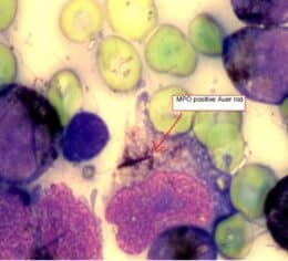 Myeloperoxidase Stain(MPO)-principle ,procedure ,uses